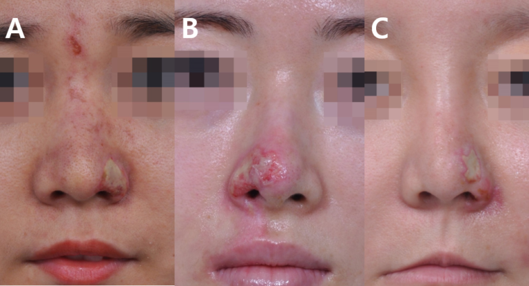 Symptoms and treatment of necrosis of the nose after filler injection ...