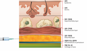 Symptoms and treatment of necrosis of the nose after filler injection ...
