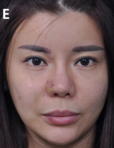 Symptoms and treatment of necrosis of the nose after filler injection ...