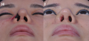 Symptoms and treatment of necrosis of the nose after filler injection ...