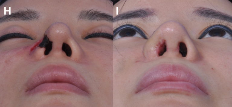 Symptoms and treatment of necrosis of the nose after filler injection ...