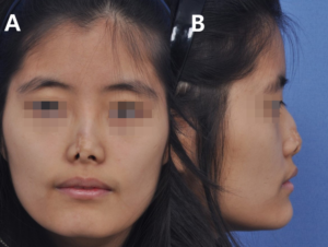 Symptoms and treatment of necrosis of the nose after filler injection ...
