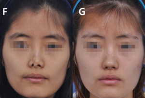 Symptoms and treatment of necrosis of the nose after filler injection ...