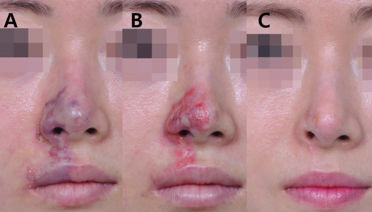 Symptoms And Treatment Of Necrosis Of The Nose After Filler Injection Rhinoplasty Archive