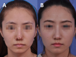 Symptoms and treatment of necrosis of the nose after filler injection ...