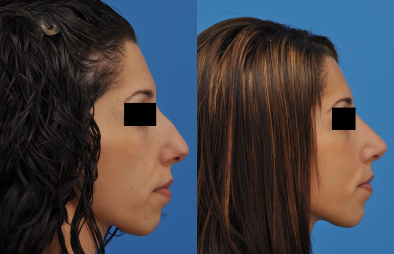 Endonasal Spreader Grafts - Rhinoplasty Archive