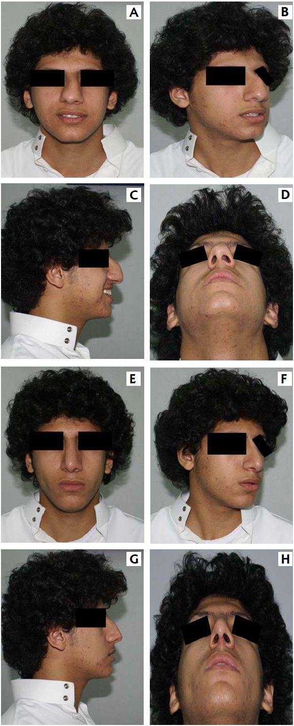 Middle East nose in Rhinoplasty - Rhinoplasty Archive