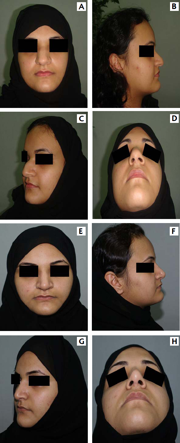 Middle East nose in Rhinoplasty - Rhinoplasty Archive