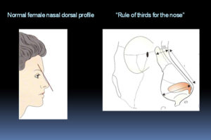 Dorsal Hump Reduction and Osteotomies