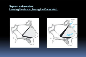 Dorsal Hump Reduction and Osteotomies