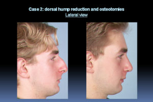 Dorsal Hump Reduction and Osteotomies