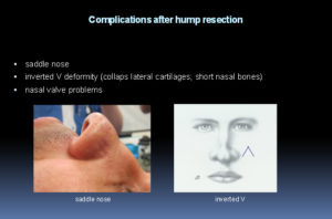 Dorsal Hump Reduction and Osteotomies