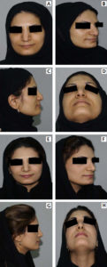 Polly Beak Deformity - Rhinoplasty Archive