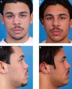 Surgical Treatment of Nasal Obstruction in Rhinoplasty