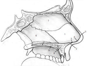 Repair of Septal Perforations in Revision Septoplasty