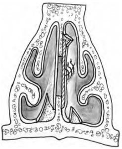 Repair of Septal Perforations in Revision Septoplasty