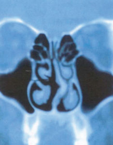 Surgical Treatment of Nasal Obstruction in Rhinoplasty