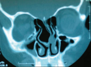 Surgical Treatment of Nasal Obstruction in Rhinoplasty