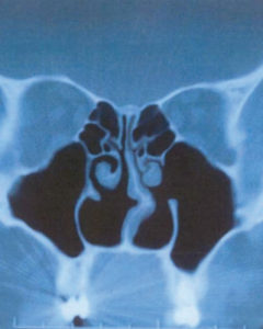 Surgical Treatment of Nasal Obstruction in Rhinoplasty