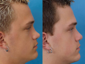 Lecture On Osteotomies - Rhinoplasty Archive