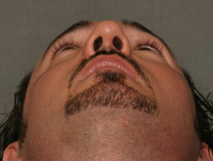 Treatment of the Caudal Septum - Rhinoplasty Archive