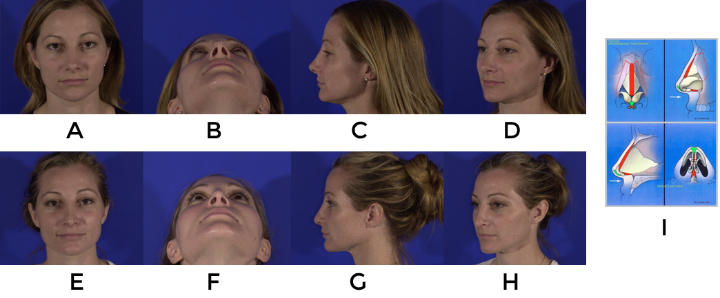 Revision tip rhinoplasty - Rhinoplasty Archive