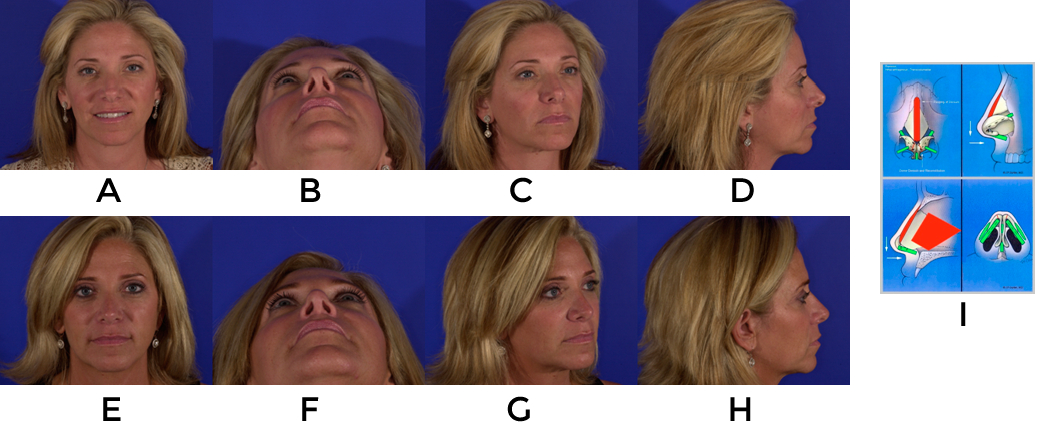 Revision tip rhinoplasty - Rhinoplasty Archive