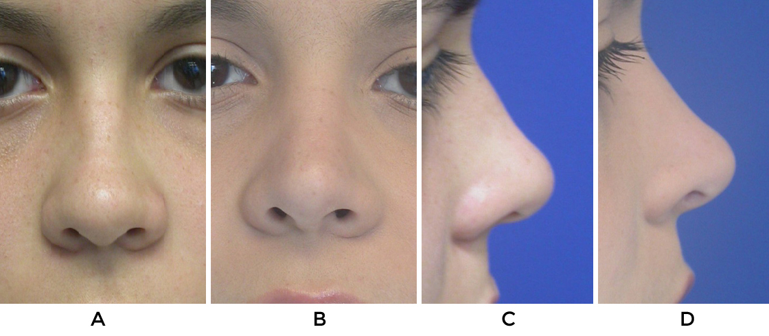 Rhinoplasty in the Latino Nose - Rhinoplasty Archive