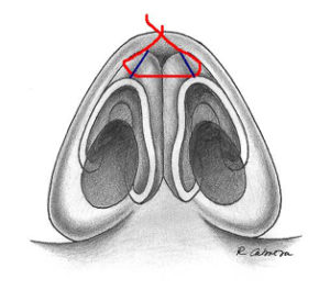 Rhinoplasty in the Latino Nose - Rhinoplasty Archive