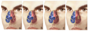 Septal Perforation - Rhinoplasty Archive
