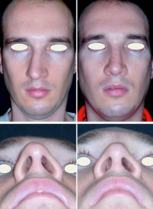 The Deviated Nose - Rhinoplasty Archive