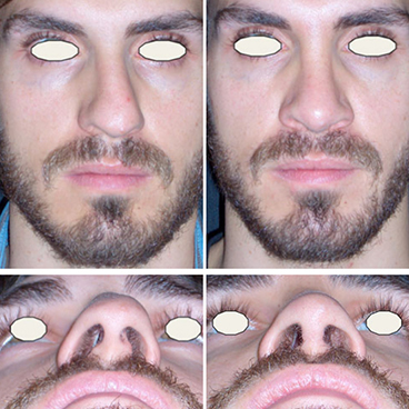 The Deviated Nose - Rhinoplasty Archive