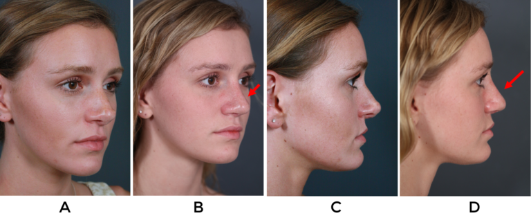 Use of The Diced Cartilage Glue Graft in Rhinoplasty - Rhinoplasty Archive
