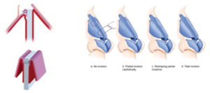 Functional grafts in rhinoplasty - Rhinoplasty Archive