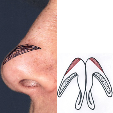 Open Rhinoplasty - Rhinoplasty Archive