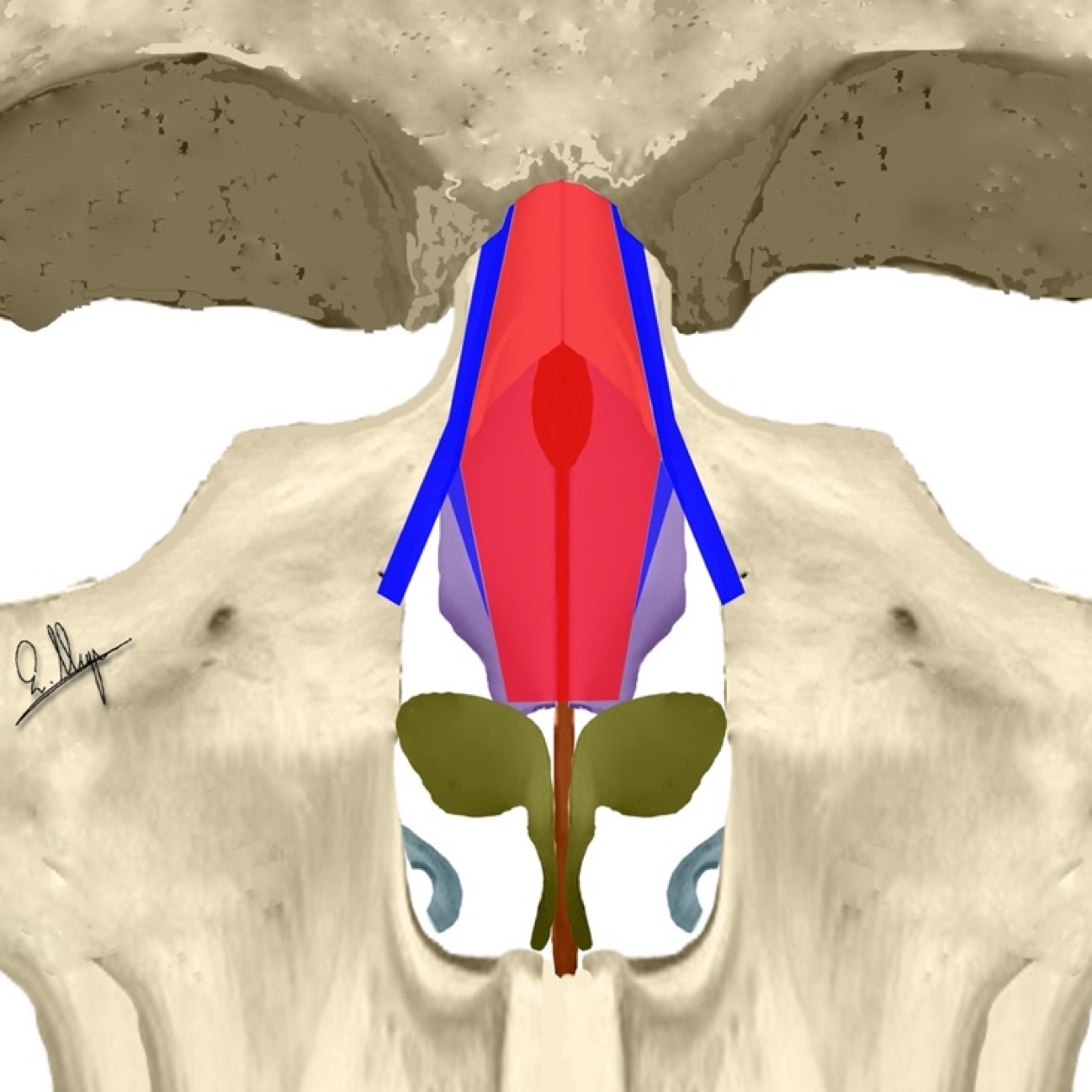 Rhinoplasty: Bony Vault Surgery with Piezoelectric Instruments ...