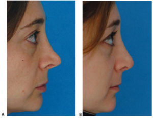 Revision Rhinoplasty Textbook - Rhinoplasty Archive