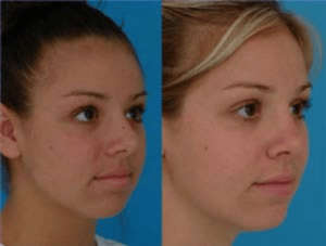 The Severely Twisted Nose - Rhinoplasty Archive