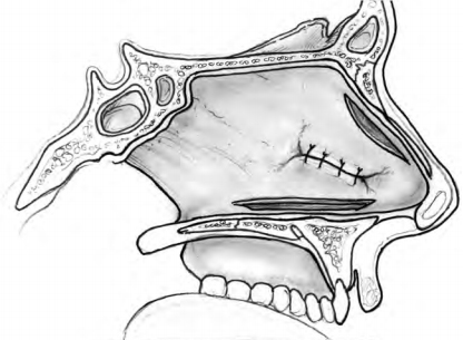 Septoplasty Anatomy