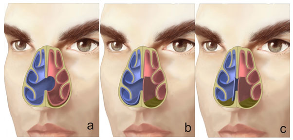 Septal Perforation | Rhinoplasty Archive